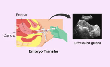 IVF Treatment in Delhi - All That You Need to Know | Dr Rhythm