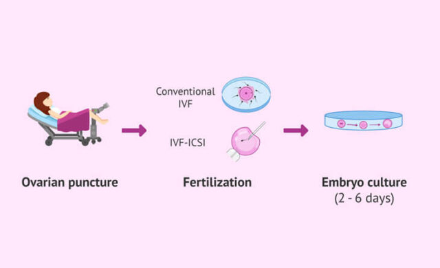 How is IVF Done Step by Step?
