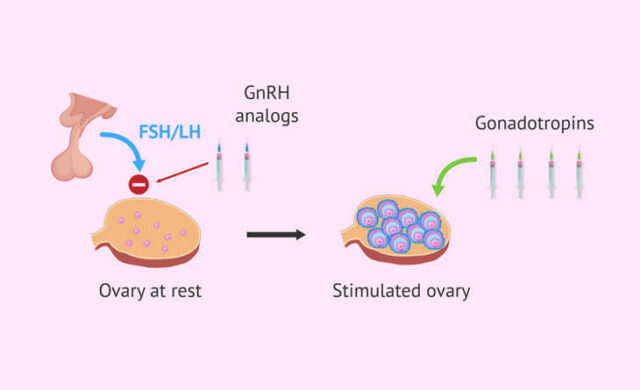 How is IVF Done Step by Step?