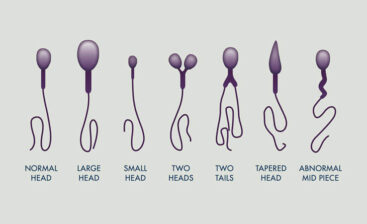 Semen Preparation Techniques for Intrauterine Insemination